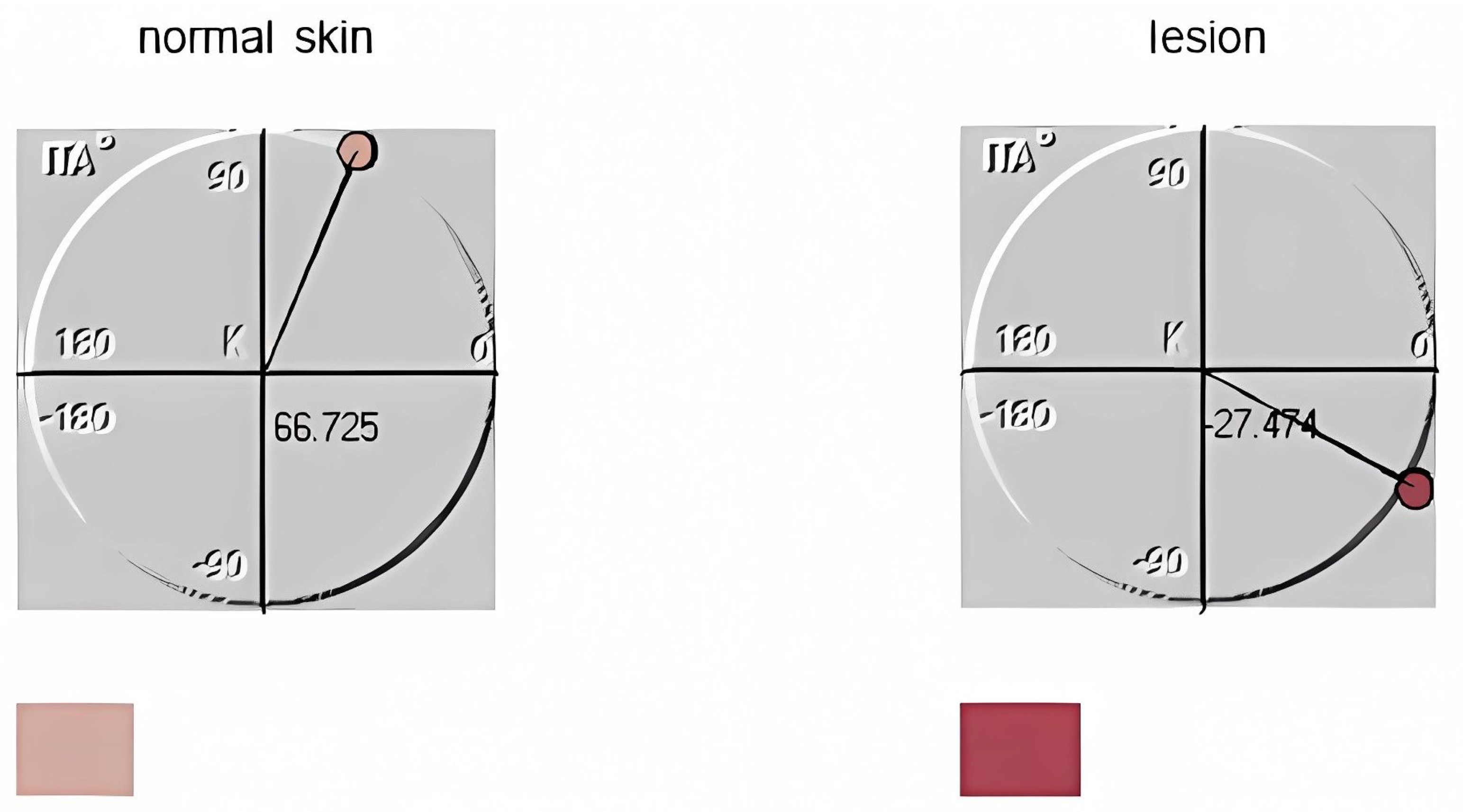 Color Analysis of Merkel Cell Carcinoma: A Comparative Study with ...