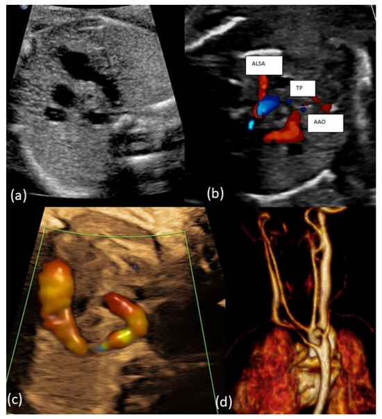 Associated Anomalies and Outcome in Patients with Prenatal Diagnosis of ...