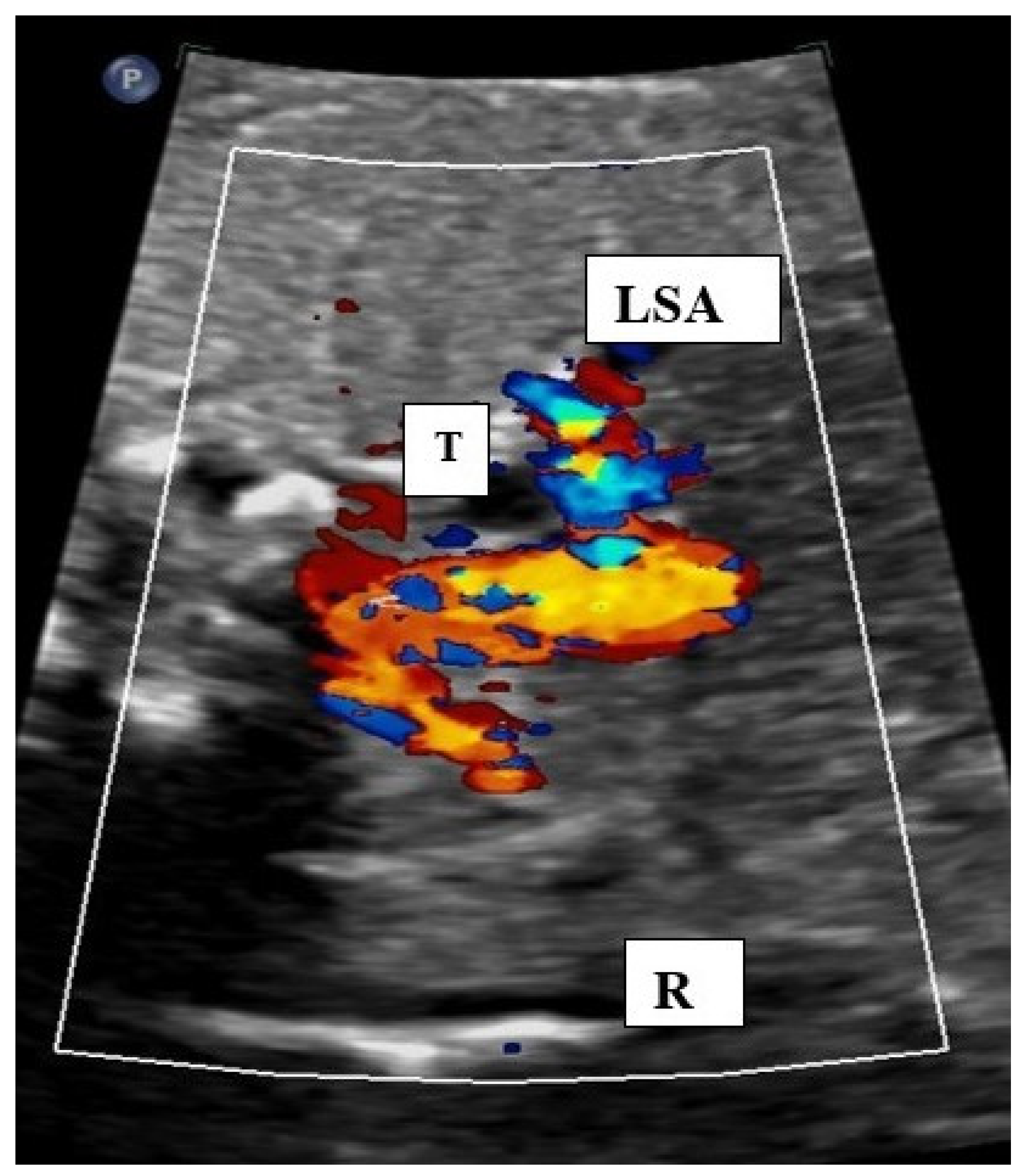 Associated Anomalies and Outcome in Patients with Prenatal Diagnosis of ...