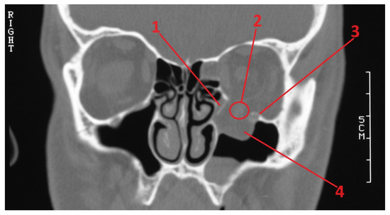 Correlation between Tomography Scan Findings and Clinical Presentation ...