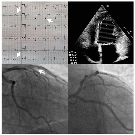 Inflammation—A Possible Link between Myocarditis and Arrhythmogenic ...