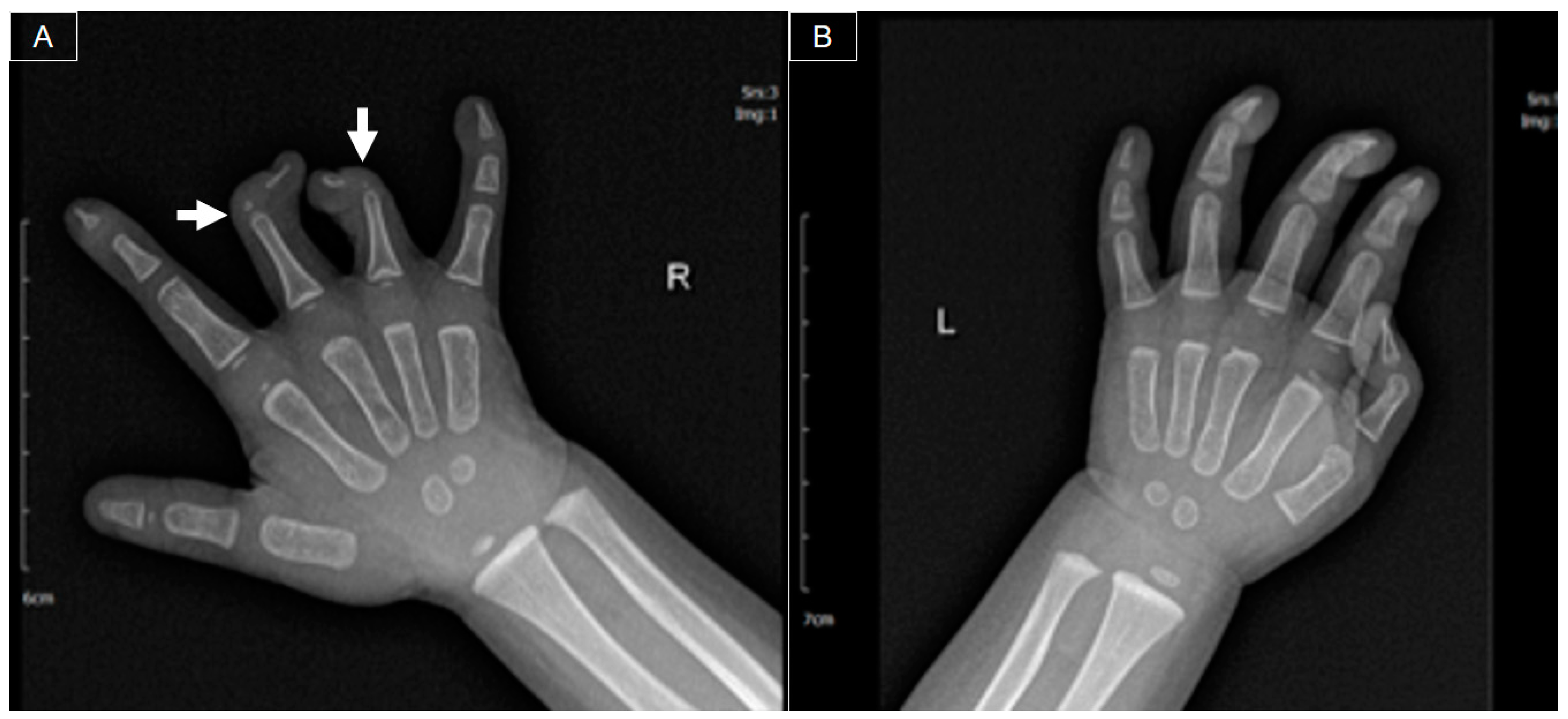 Ultrasonographic Diagnosis of Finger Flexor Tendon Hypoplasia in a ...