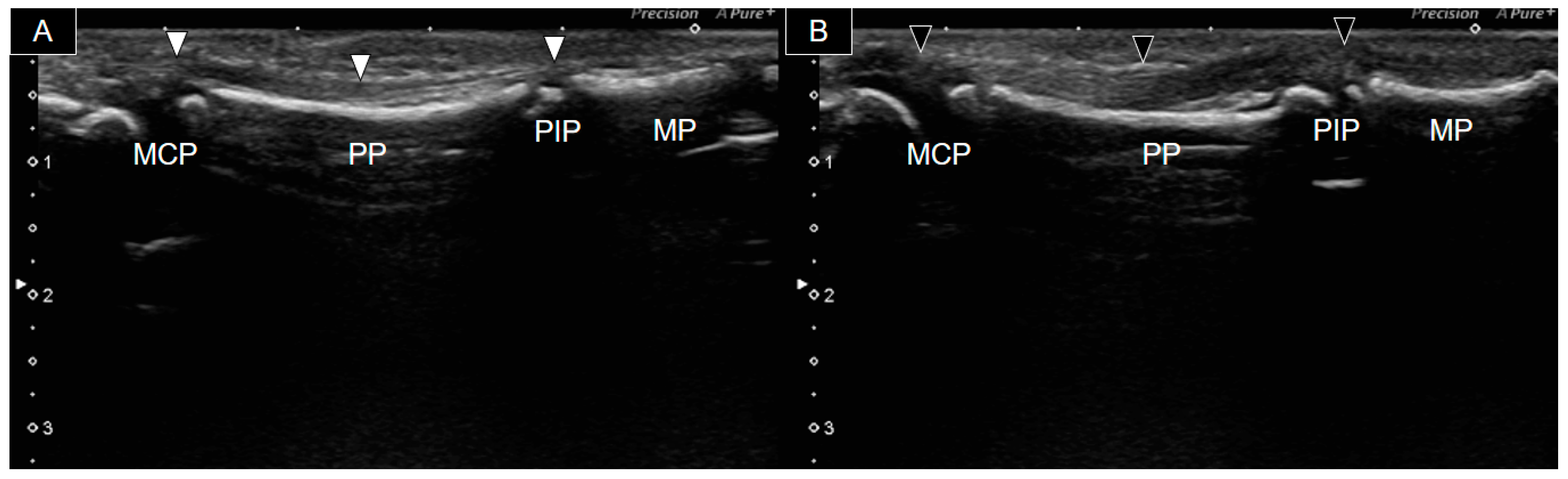 Ultrasonographic Diagnosis of Finger Flexor Tendon Hypoplasia in a ...