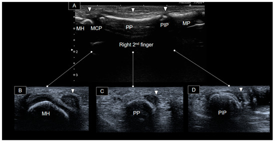 Ultrasonographic Diagnosis of Finger Flexor Tendon Hypoplasia in a ...