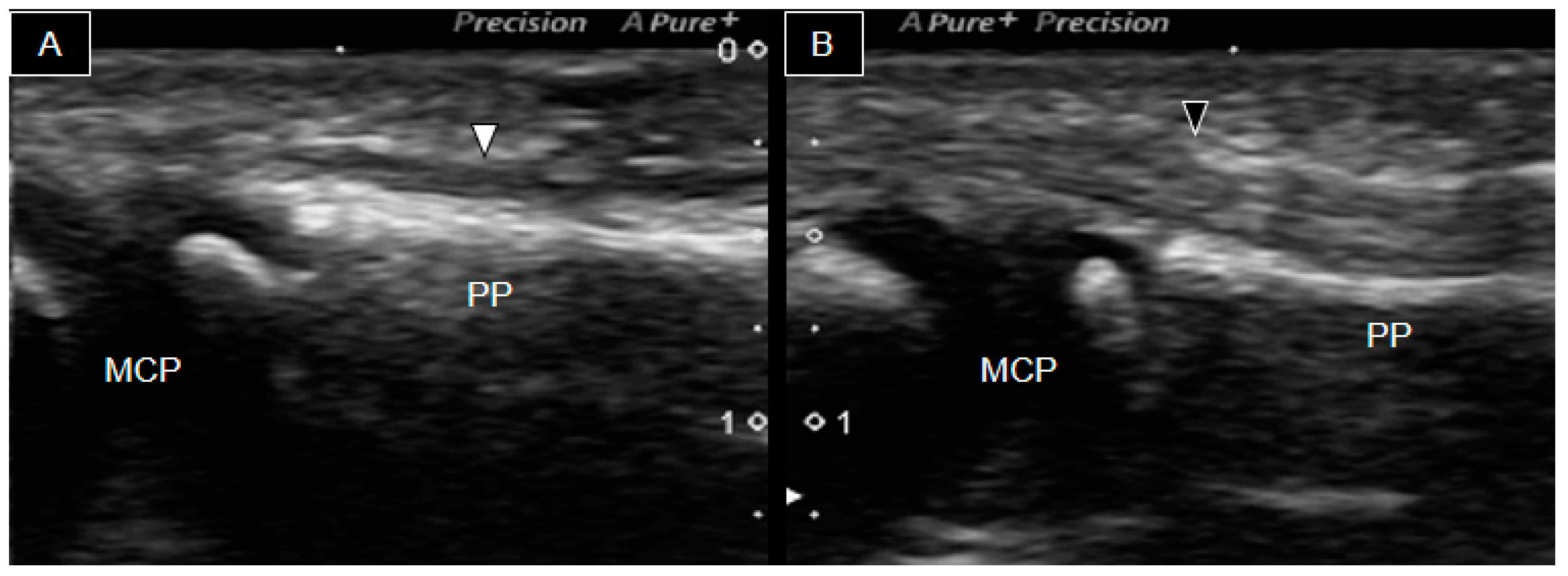 Ultrasonographic Diagnosis of Finger Flexor Tendon Hypoplasia in a ...