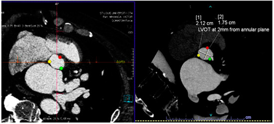 Artificial Intelligence in Transcatheter Aortic Valve Replacement: Its ...