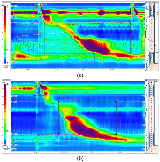 A Comparison between Chicago Classification Versions 3.0 and 4.0 and ...