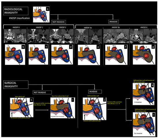 Trouillas’s Grading and Post-Surgical Tumor Residue Assessment in ...