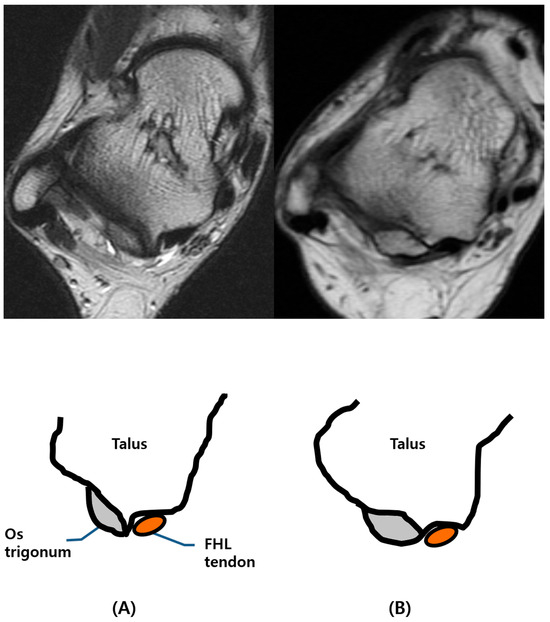 The Relationship between Types of Os Trigonum and Findings of ...