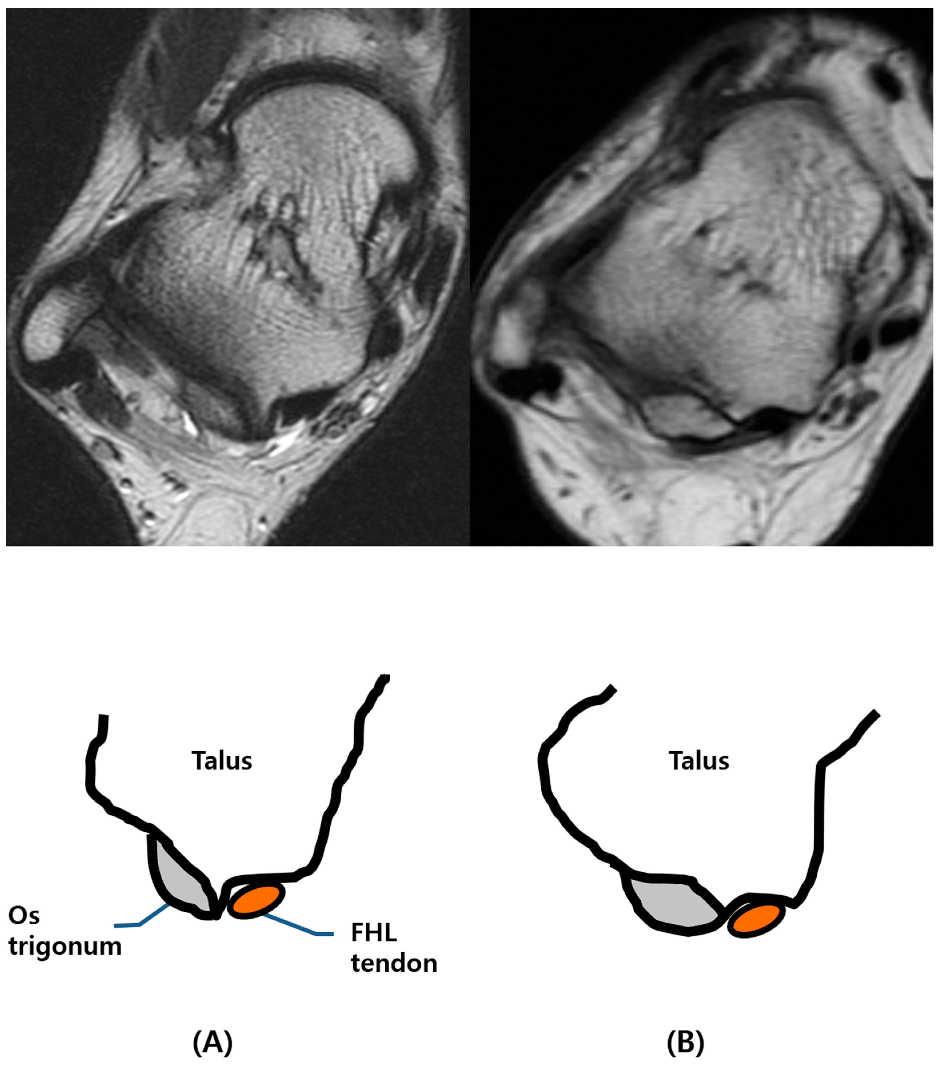 The Relationship between Types of Os Trigonum and Findings of ...