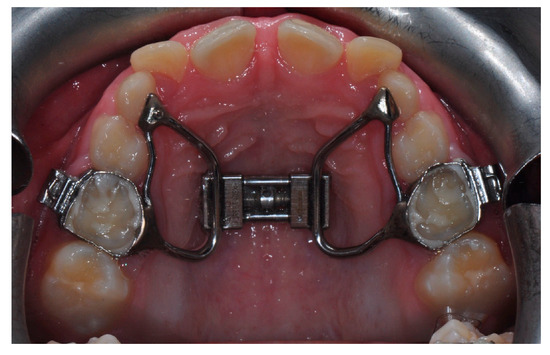 Diagnosis and Orthodontic Treatment of Obstructive Sleep Apnea Syndrome ...
