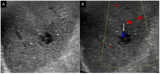 Multimodality Imaging of Primary Hepatic Lymphoma: A Case Report and a ...