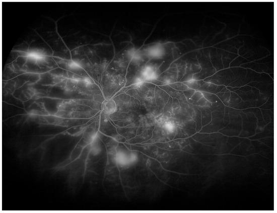 Advantages of the Utilization of Wide-Field OCT and Wide-Field OCT ...