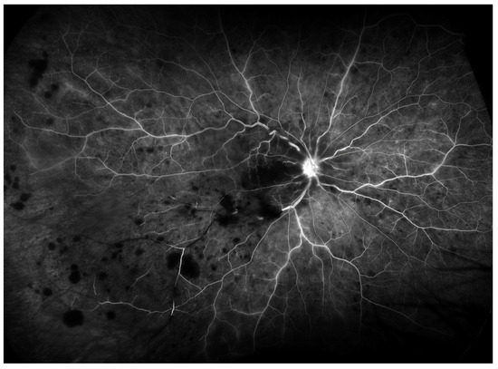 Advantages of the Utilization of Wide-Field OCT and Wide-Field OCT ...