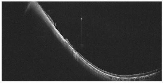 Advantages of the Utilization of Wide-Field OCT and Wide-Field OCT ...