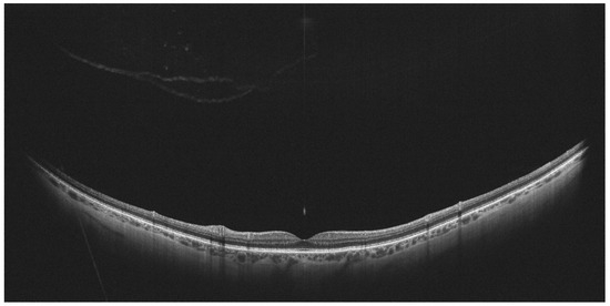 Advantages of the Utilization of Wide-Field OCT and Wide-Field OCT ...