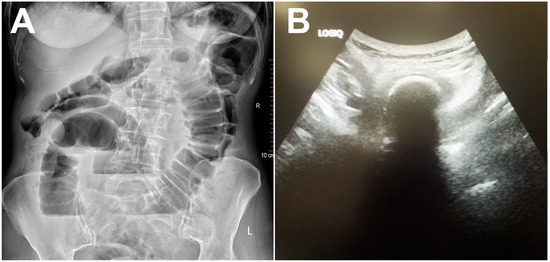 “Bezoar Egg”—A Rare Cause of Small Bowel Obstruction