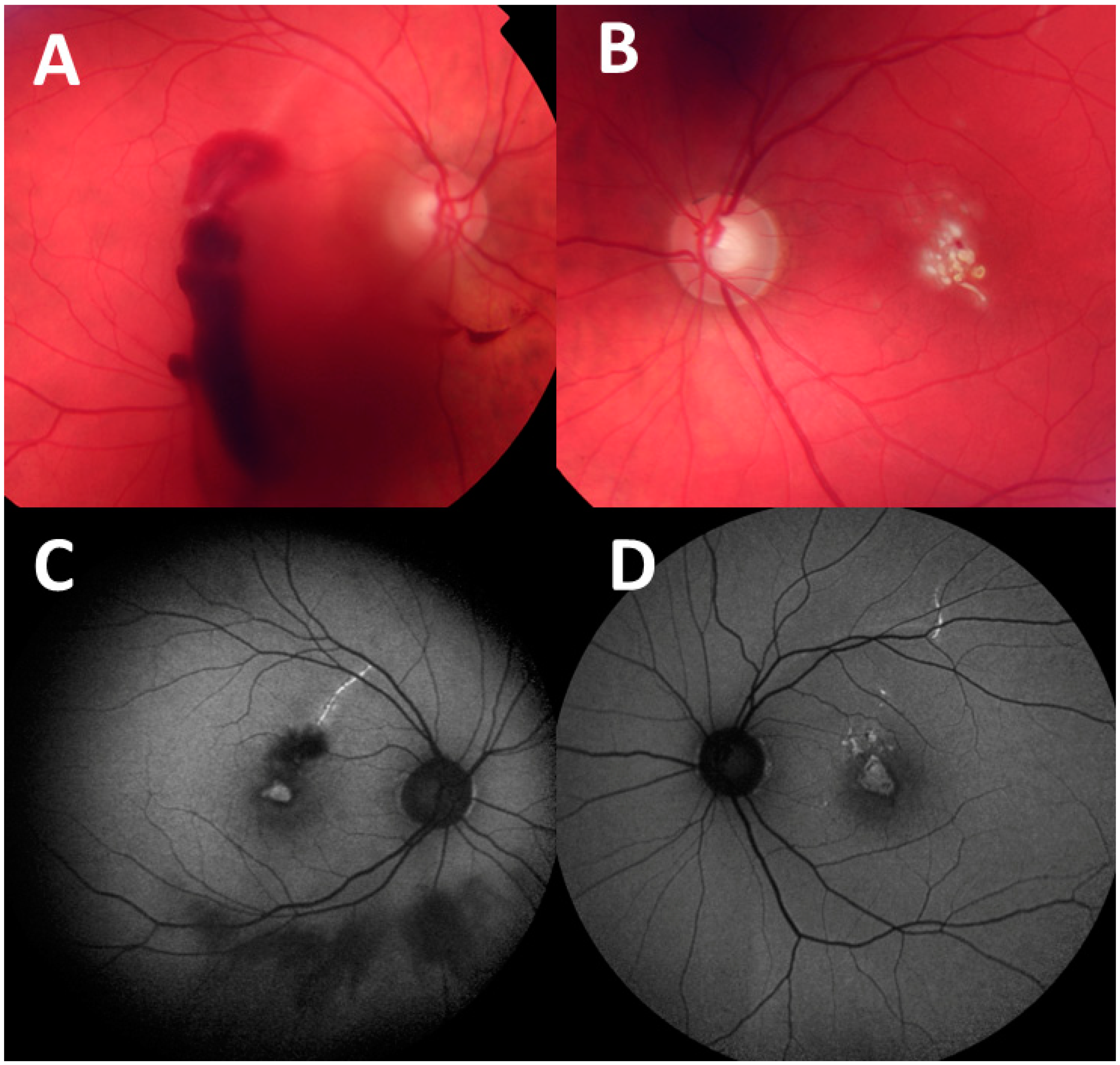 Self-Inflicted Laser-Induced Retinopathy