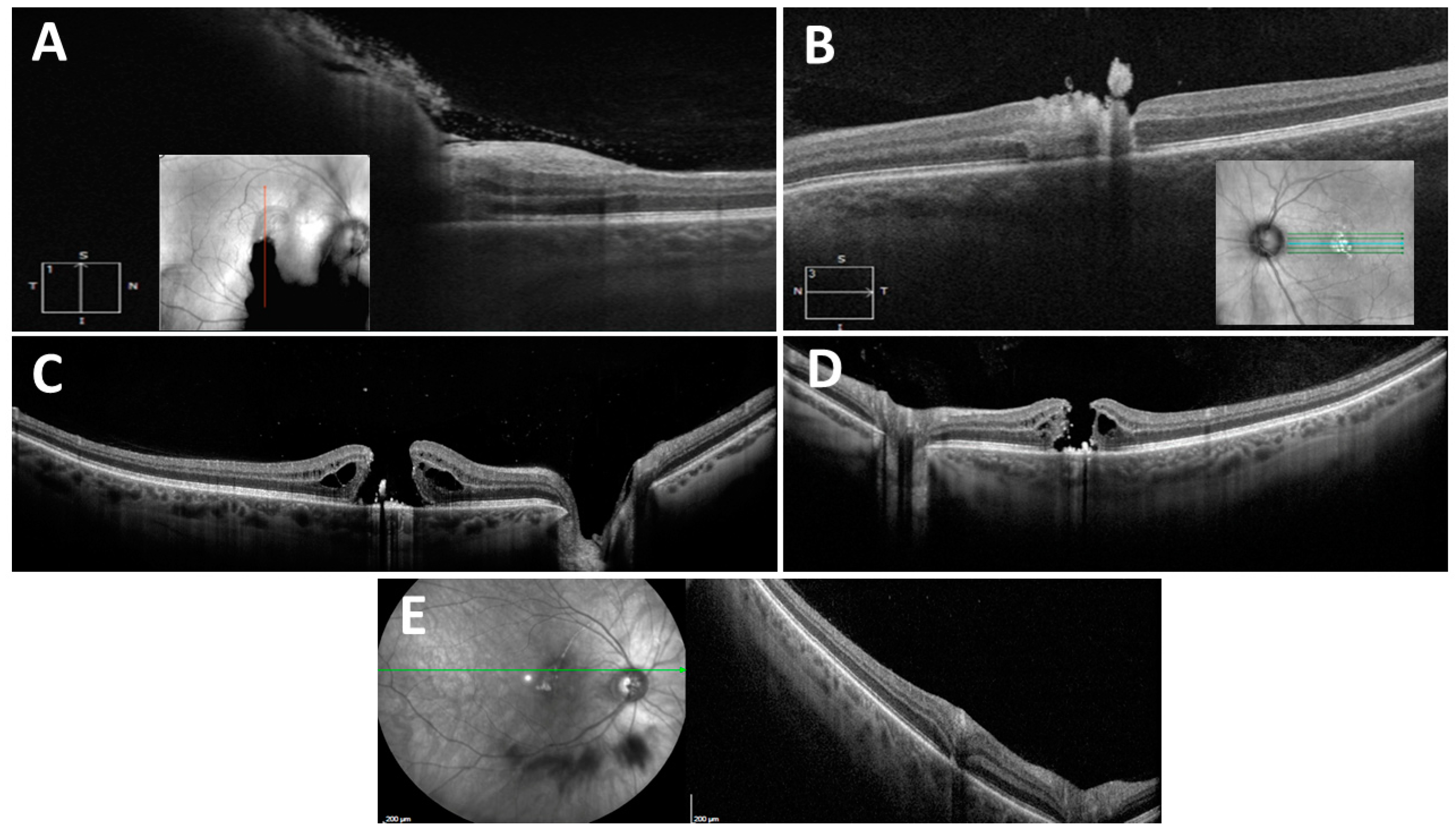 Self-Inflicted Laser-Induced Retinopathy