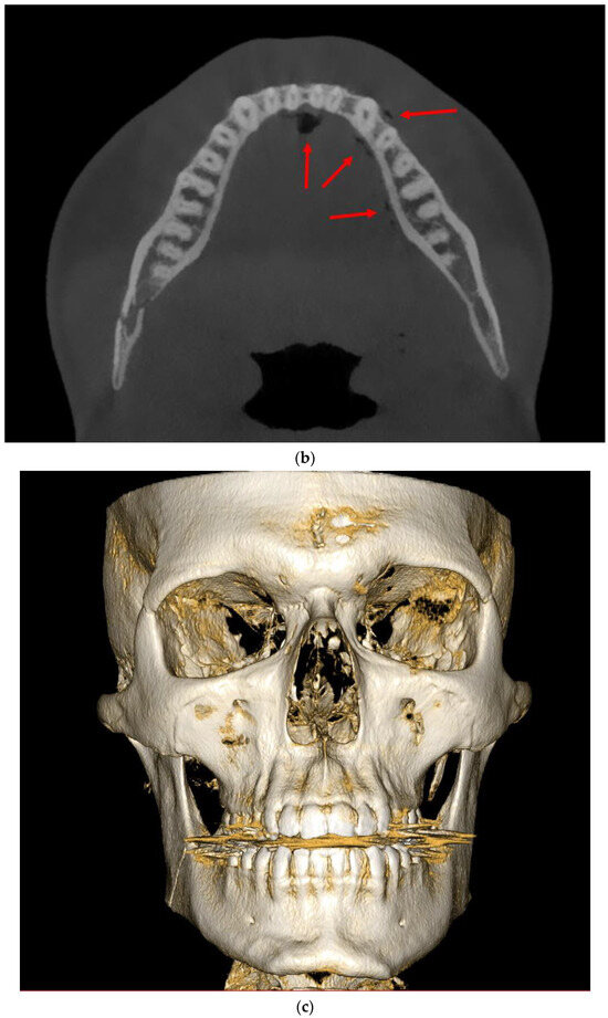“Air Sign” in Misdiagnosed Mandibular Fractures Based on CT and CBCT ...