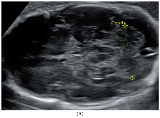 Agreement between Fetal Brain Ultrasonography and Magnetic Resonance ...