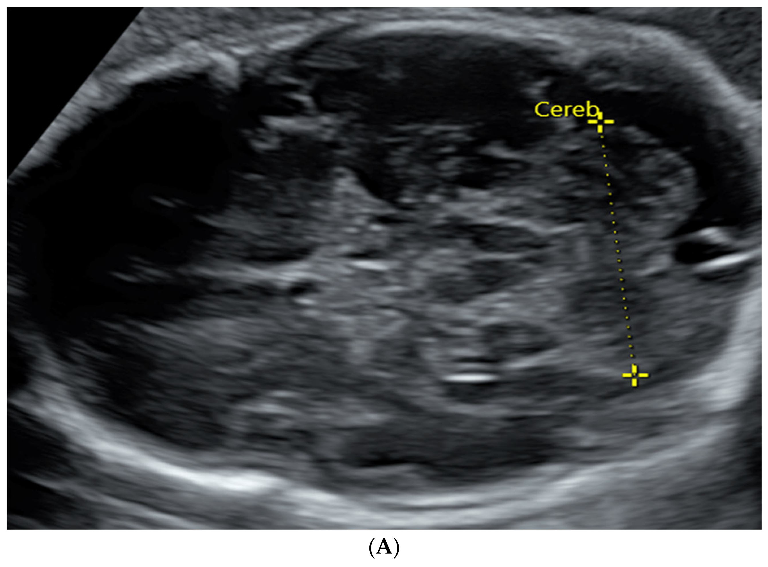 Agreement between Fetal Brain Ultrasonography and Magnetic Resonance ...