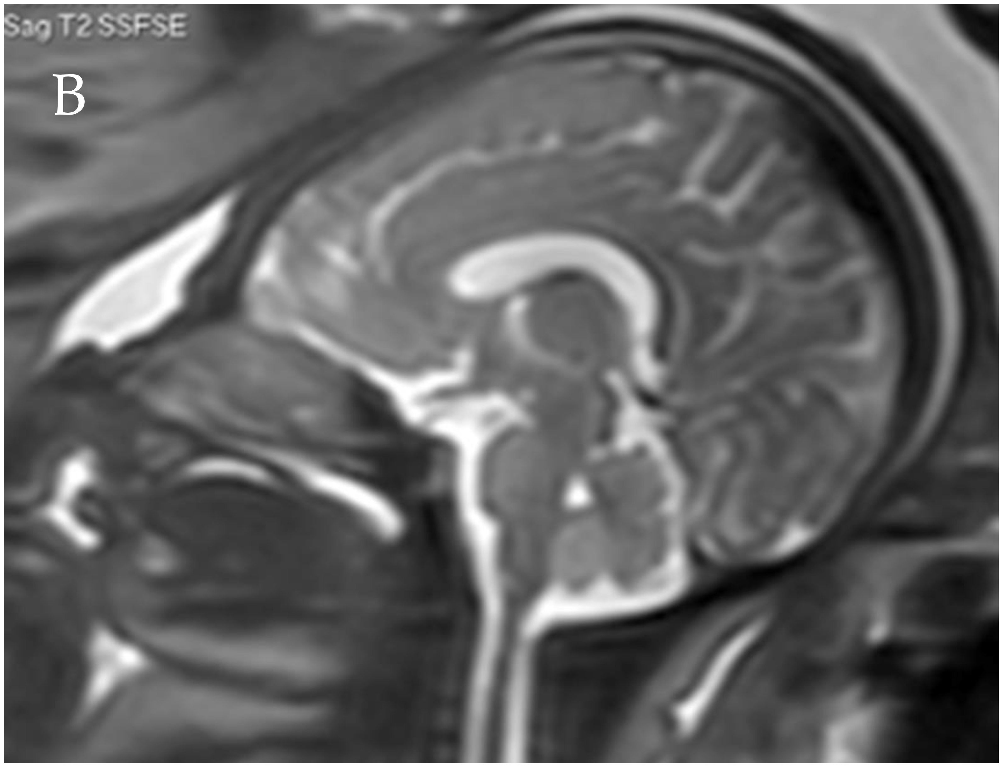 Agreement between Fetal Brain Ultrasonography and Magnetic Resonance ...