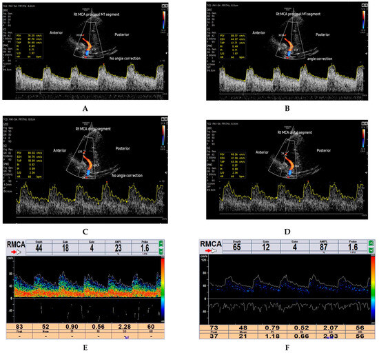 A Comparative Study of Transcranial Color-Coded Doppler (TCCD) and Transcranial Doppler (TCD ...