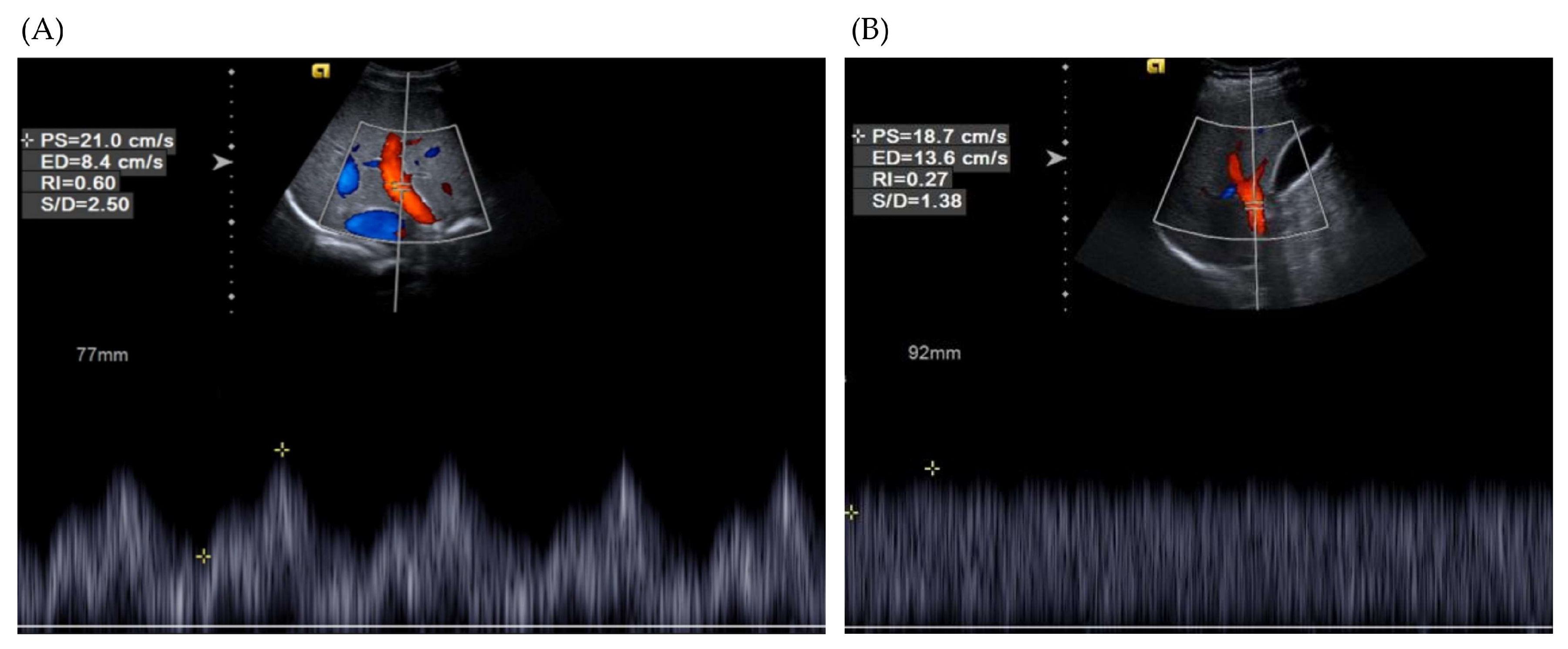 The Portal Venous Pulsatility Index and Main Portal Vein Diameter as ...