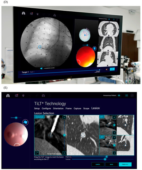 Robotic-Assisted Bronchoscopy: A Comprehensive Review of System ...