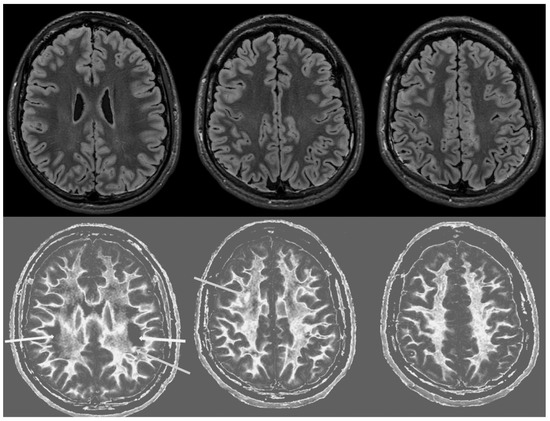 Diagnosis of Delayed Post-Hypoxic Leukoencephalopathy (Grinker’s ...