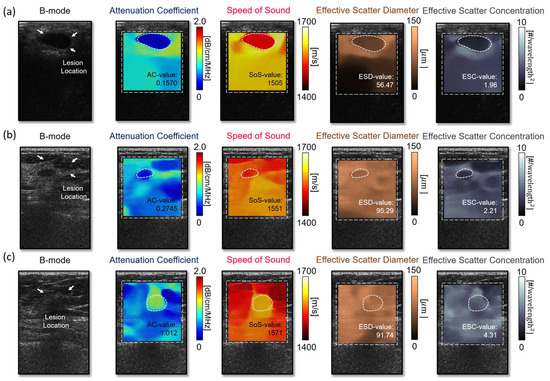 Artificial Intelligence-Enhanced Quantitative Ultrasound for Breast ...