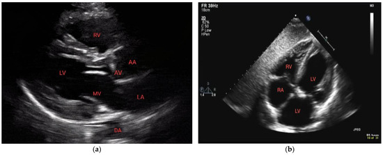 Point-of-Care Ultrasound (POCUS) in Adult Cardiac Arrest: Clinical Review