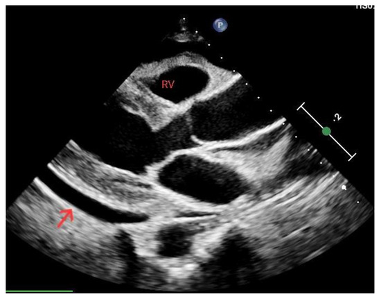 Point-of-Care Ultrasound (POCUS) in Adult Cardiac Arrest: Clinical Review