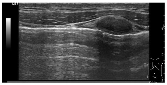 Point-of-Care Ultrasound (POCUS) in Adult Cardiac Arrest: Clinical Review