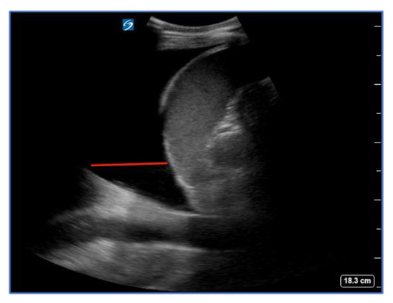 Point-of-Care Ultrasound (POCUS) in Adult Cardiac Arrest: Clinical Review