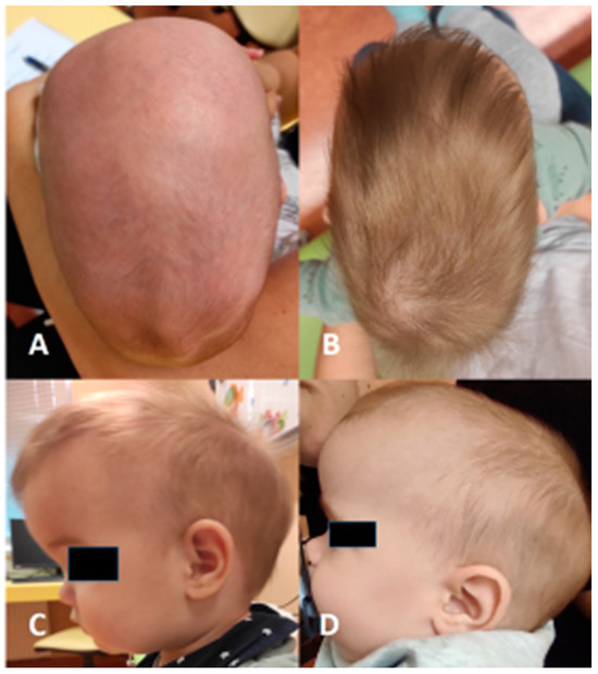 Isolated Sagittal Craniosynostosis: A Comprehensive Review