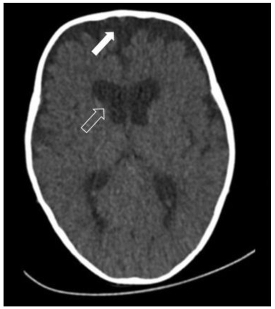 Isolated Sagittal Craniosynostosis: A Comprehensive Review