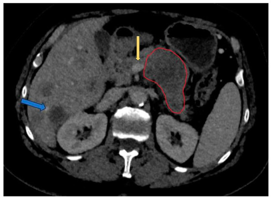 Pancreatic Adenocarcinoma: Imaging Modalities and the Role of ...