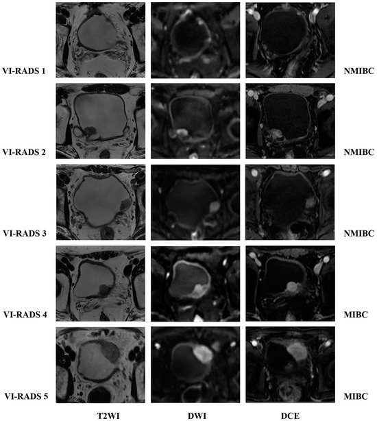 Progress of Multiparameter Magnetic Resonance Imaging in Bladder Cancer ...