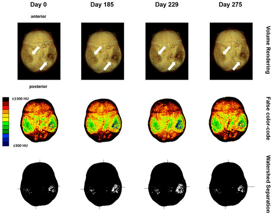 Long-Term Comparison of Two- and Three-Dimensional Computed Tomography ...