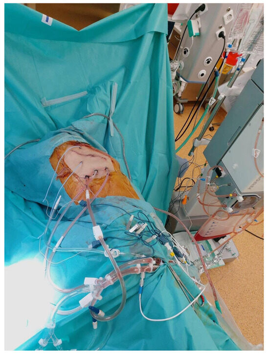 Successful Implementation of HITOC and HIPEC in the Management of ...