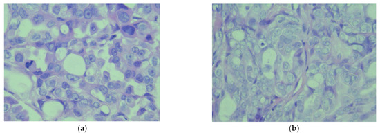 Successful Implementation of HITOC and HIPEC in the Management of ...