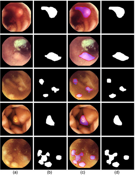 Polypoid Lesion Segmentation Using YOLO-V8 Network in Wireless Video ...