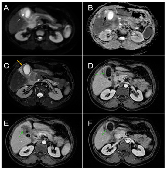 The Many Hidden Faces of Gallbladder Carcinoma on CT and MRI Imaging ...