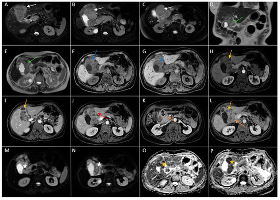 The Many Hidden Faces of Gallbladder Carcinoma on CT and MRI Imaging ...