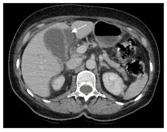 The Many Hidden Faces of Gallbladder Carcinoma on CT and MRI Imaging ...