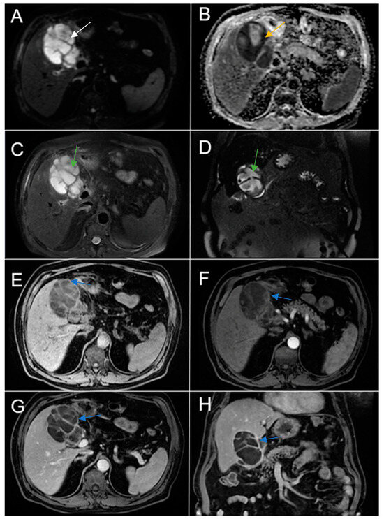 The Many Hidden Faces of Gallbladder Carcinoma on CT and MRI Imaging ...