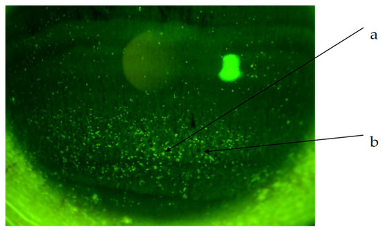 The Features and Treatment Effects on Keratoepitheliopathy for ...