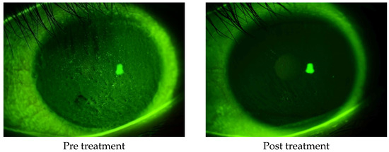 The Features and Treatment Effects on Keratoepitheliopathy for ...